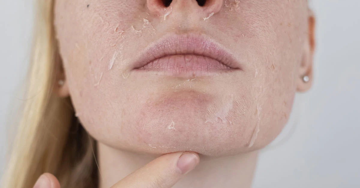 How To Get Rid of Peeling Skin: 4 Effective Steps – Solvaderm
