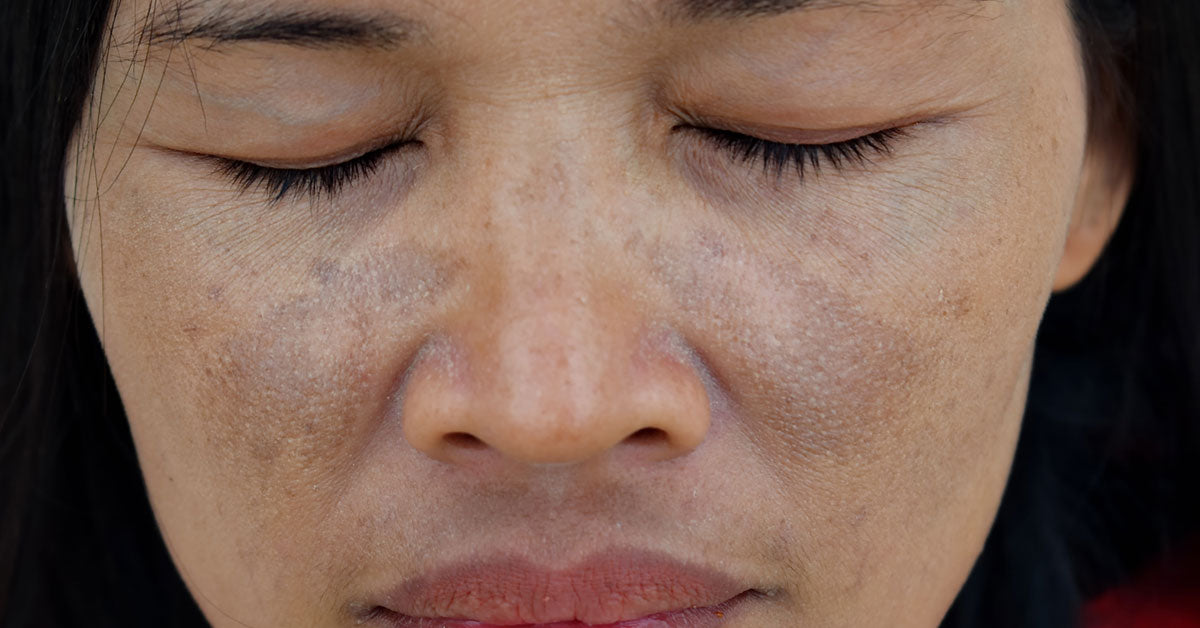 Hemochromatosis Bronze Skin